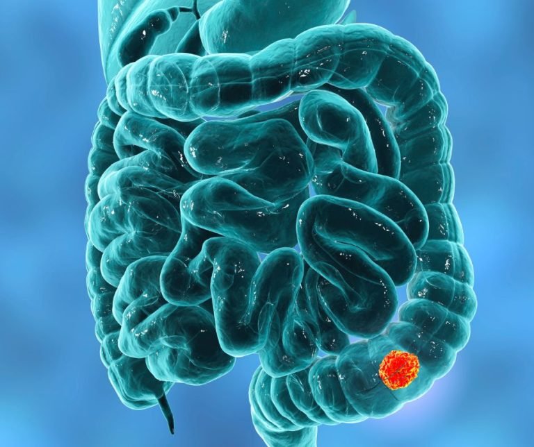 Is Your Colon Full of Poop? Signs You Shouldn’t Ignore